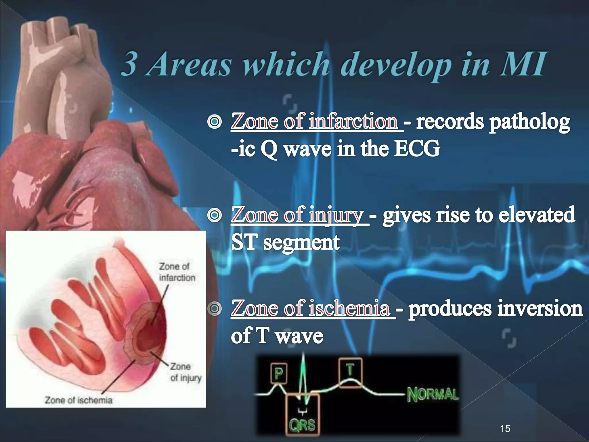 Myocardial infarction by Himaja.donthula | PPT