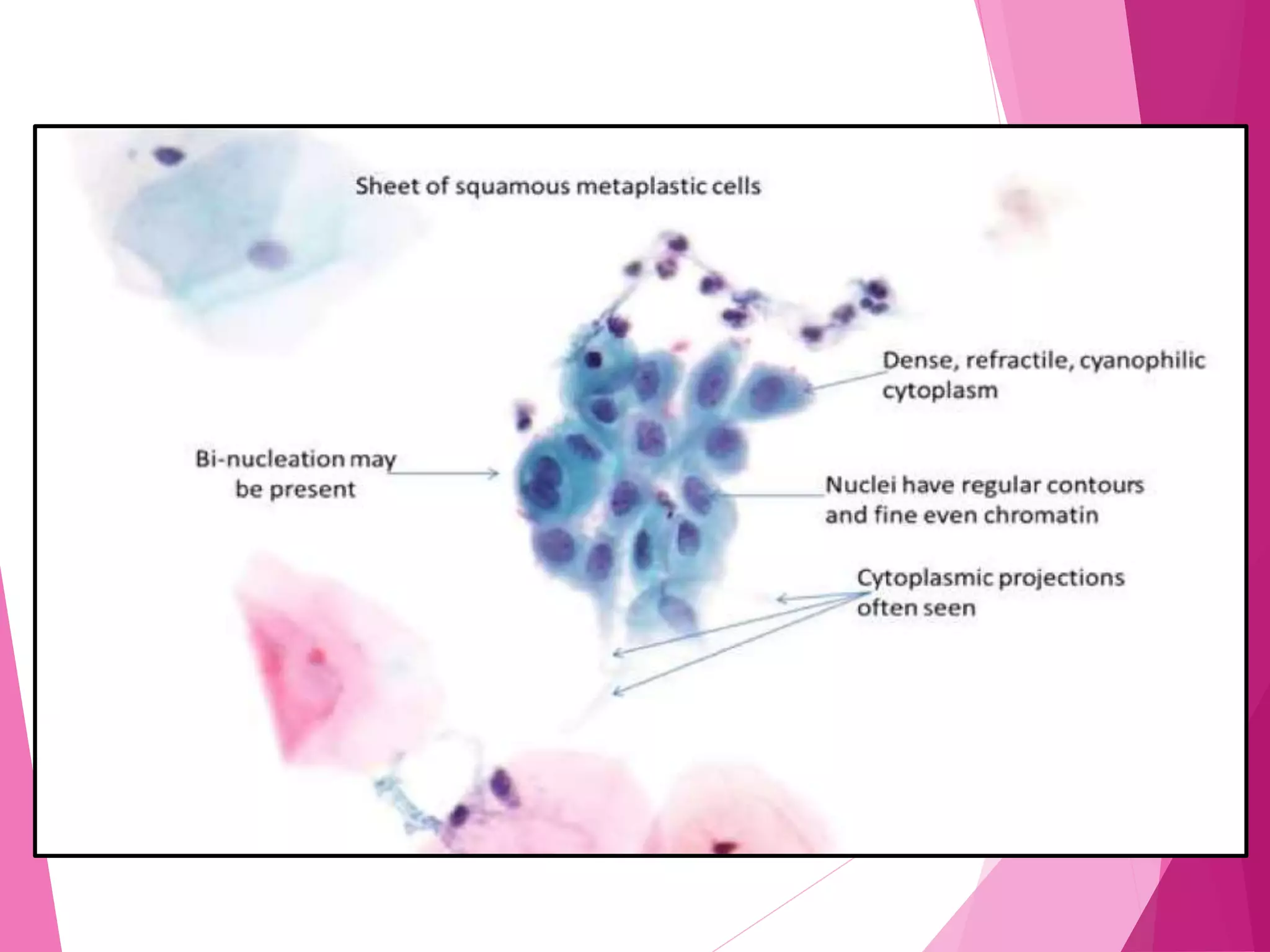 Bethesda system for cervix cytology | PPTX