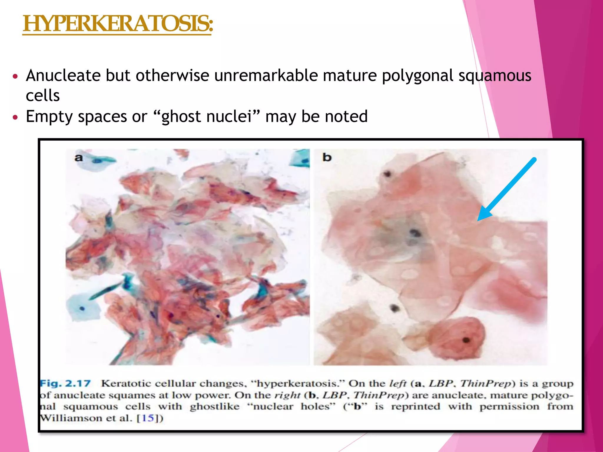 Bethesda system for cervix cytology | PPTX