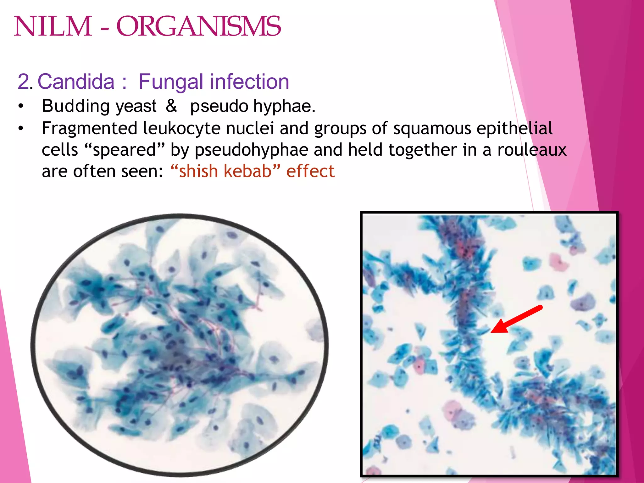 Bethesda system for cervix cytology | PPTX