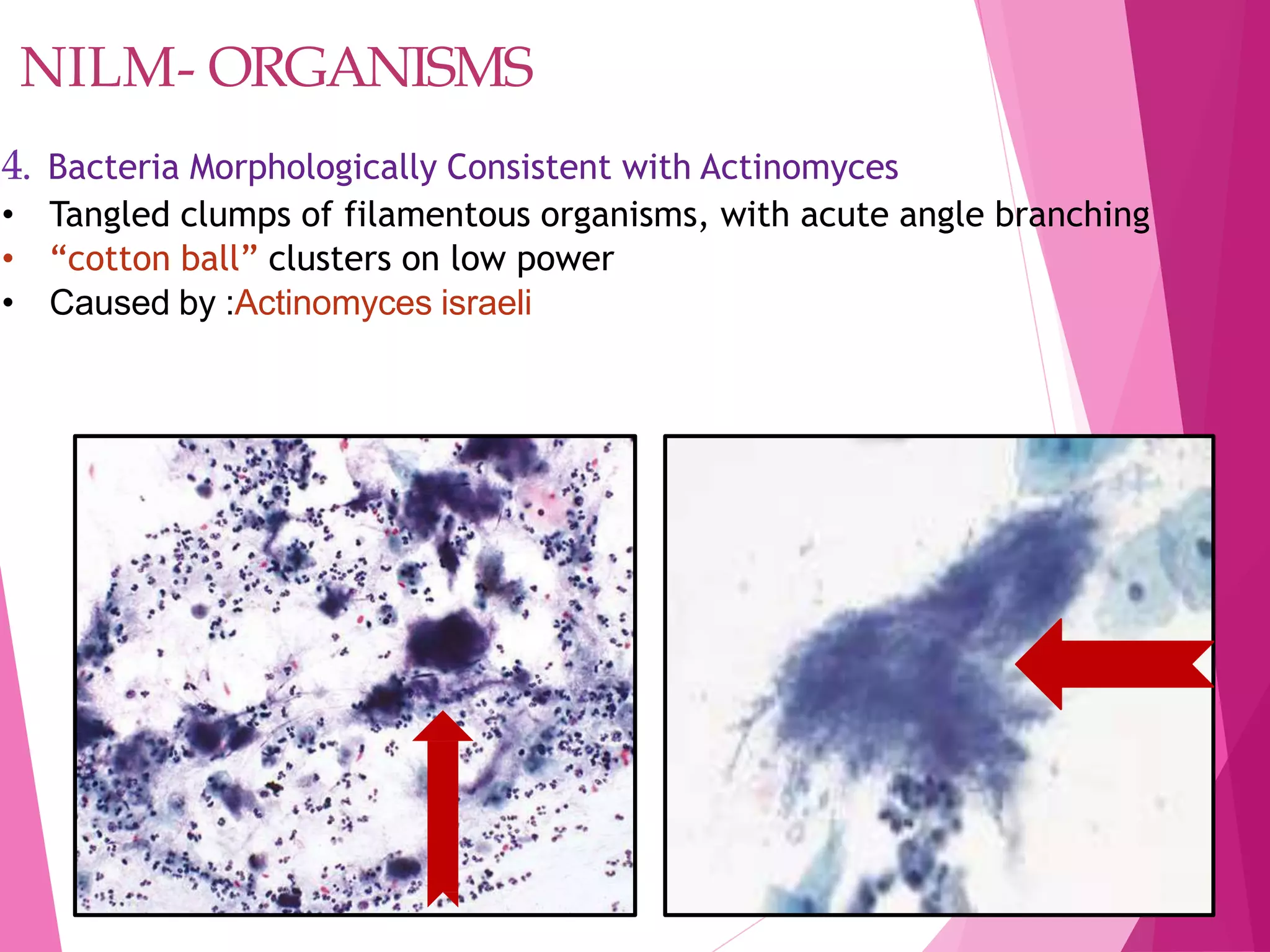 Bethesda system for cervix cytology | PPTX