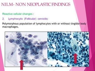 Bethesda system for cervix cytology | PPTX