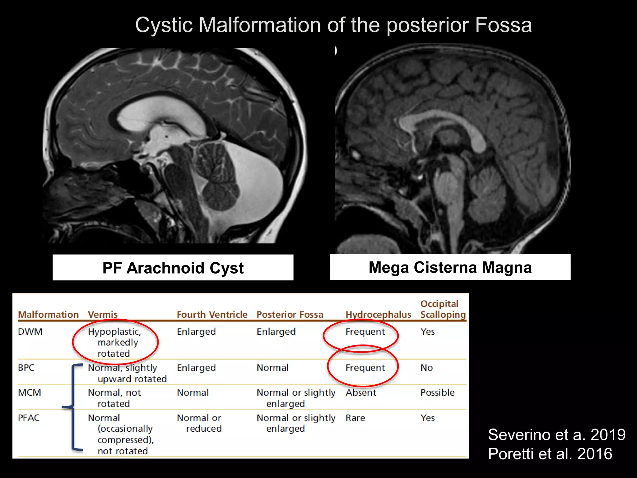 Posterior Fossa Malformations Dr Felice D'Arco | PPTX