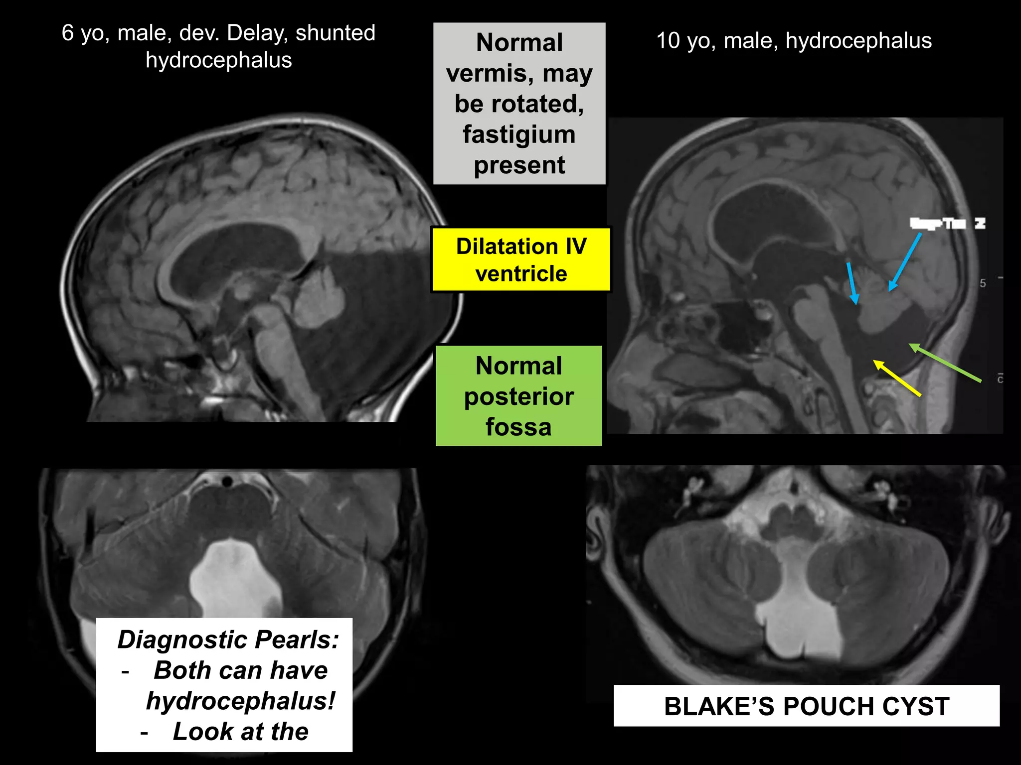 Posterior Fossa Malformations Dr Felice D'Arco | PPTX