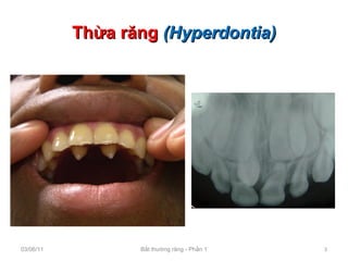 Hinh anh bat thuong rang phan 1 | PPS