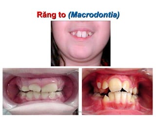 Hinh anh bat thuong rang phan 1 | PPS