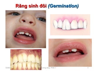 Hinh anh bat thuong rang phan 1 | PPS