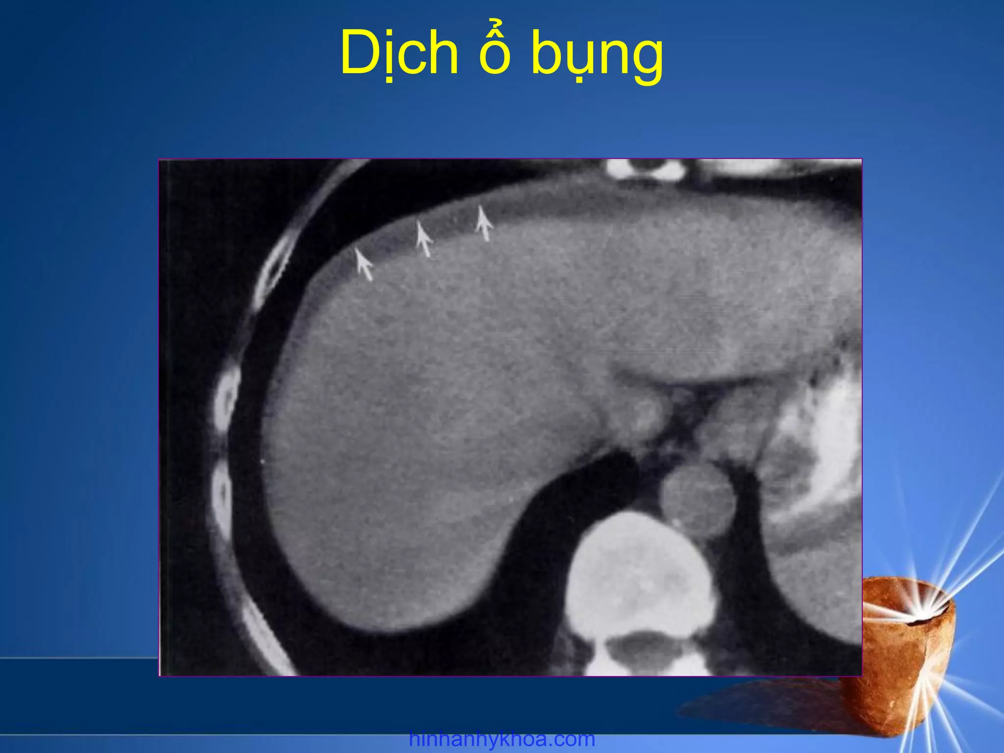 Hinh anh benh ly thanh nguc, mang phoi, co hoanh, bs mai thuy (2018) | PPT