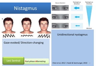 HINTS of Stroke, Bedside Eye Exam Outperforms MRI in Identifying Stroke ...