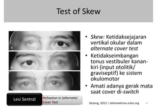 HINTS of Stroke, Bedside Eye Exam Outperforms MRI in Identifying Stroke ...