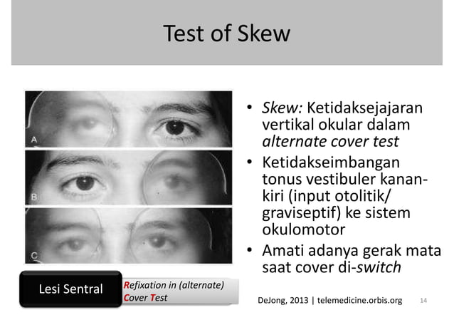 HINTS of Stroke, Bedside Eye Exam Outperforms MRI in Identifying Stroke ...