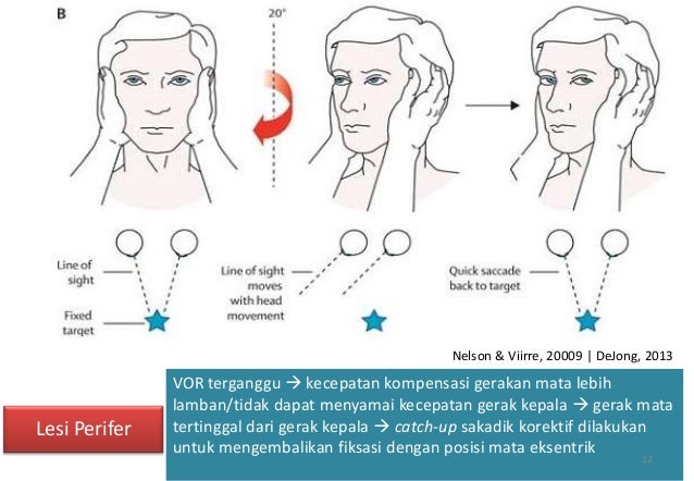 HINTS of Stroke, Bedside Eye Exam Outperforms MRI in Identifying Stro…