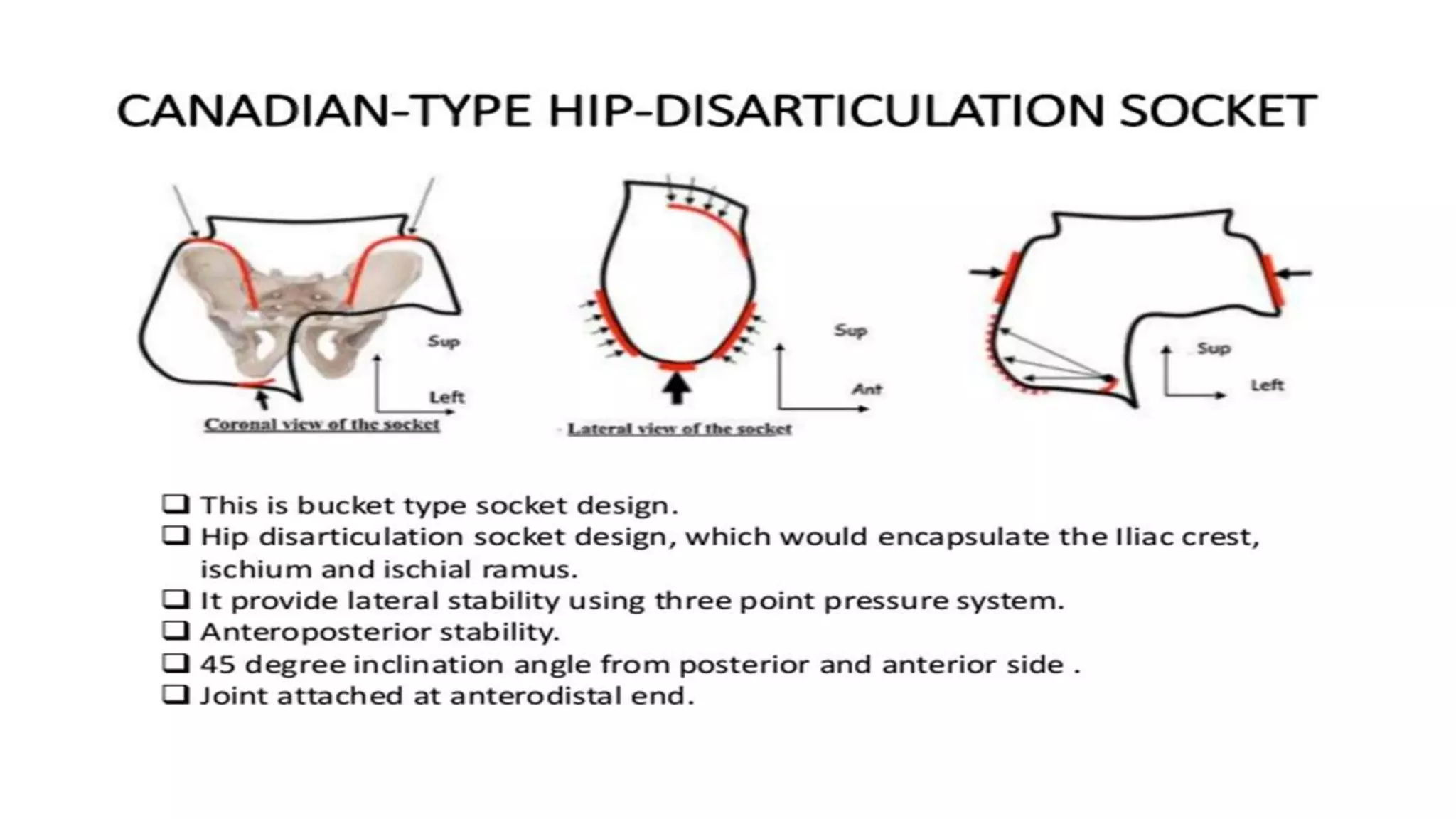 Hip Disarticulation Prosthetic Management | PPTX