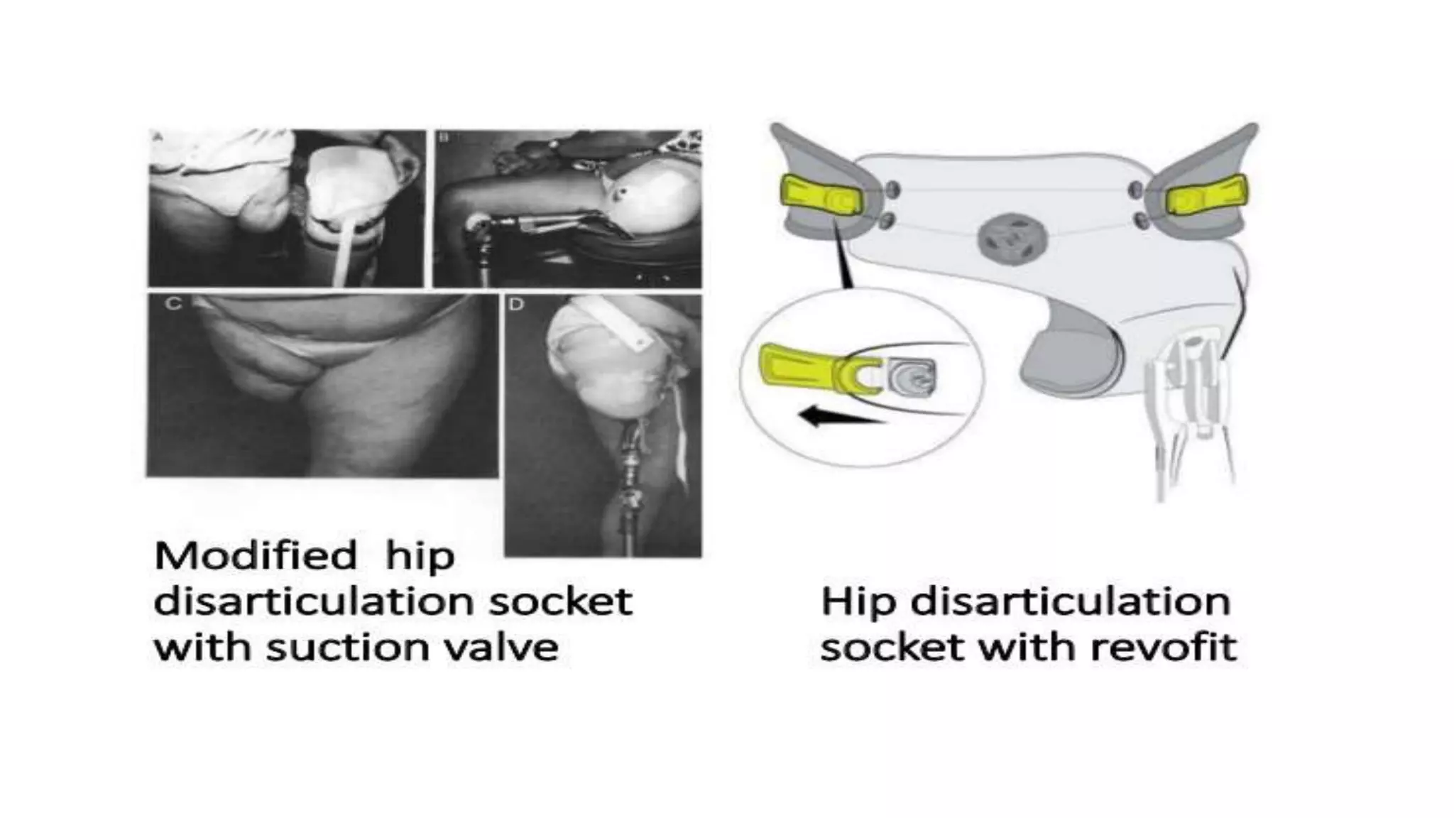 Hip Disarticulation Prosthetic Management Ppt