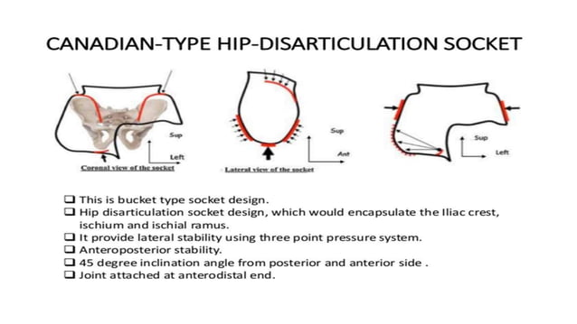 Hip Disarticulation Prosthetic Management | PPTX