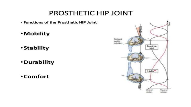 Hip Disarticulation Prosthetic Management | PPTX