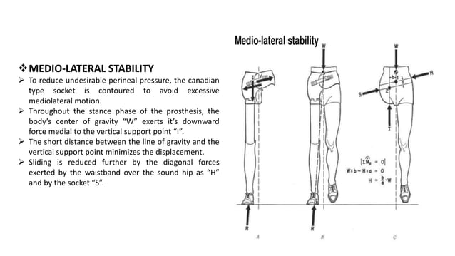 Hip Disarticulation Prosthetic Management | PPTX