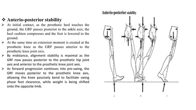 Hip Disarticulation Prosthetic Management | PPTX