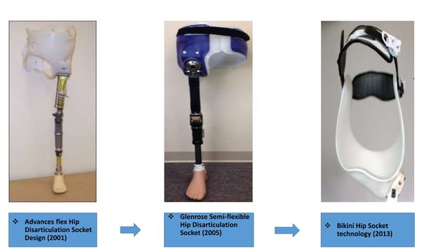 Hip Disarticulation Prosthetic Management | PPTX