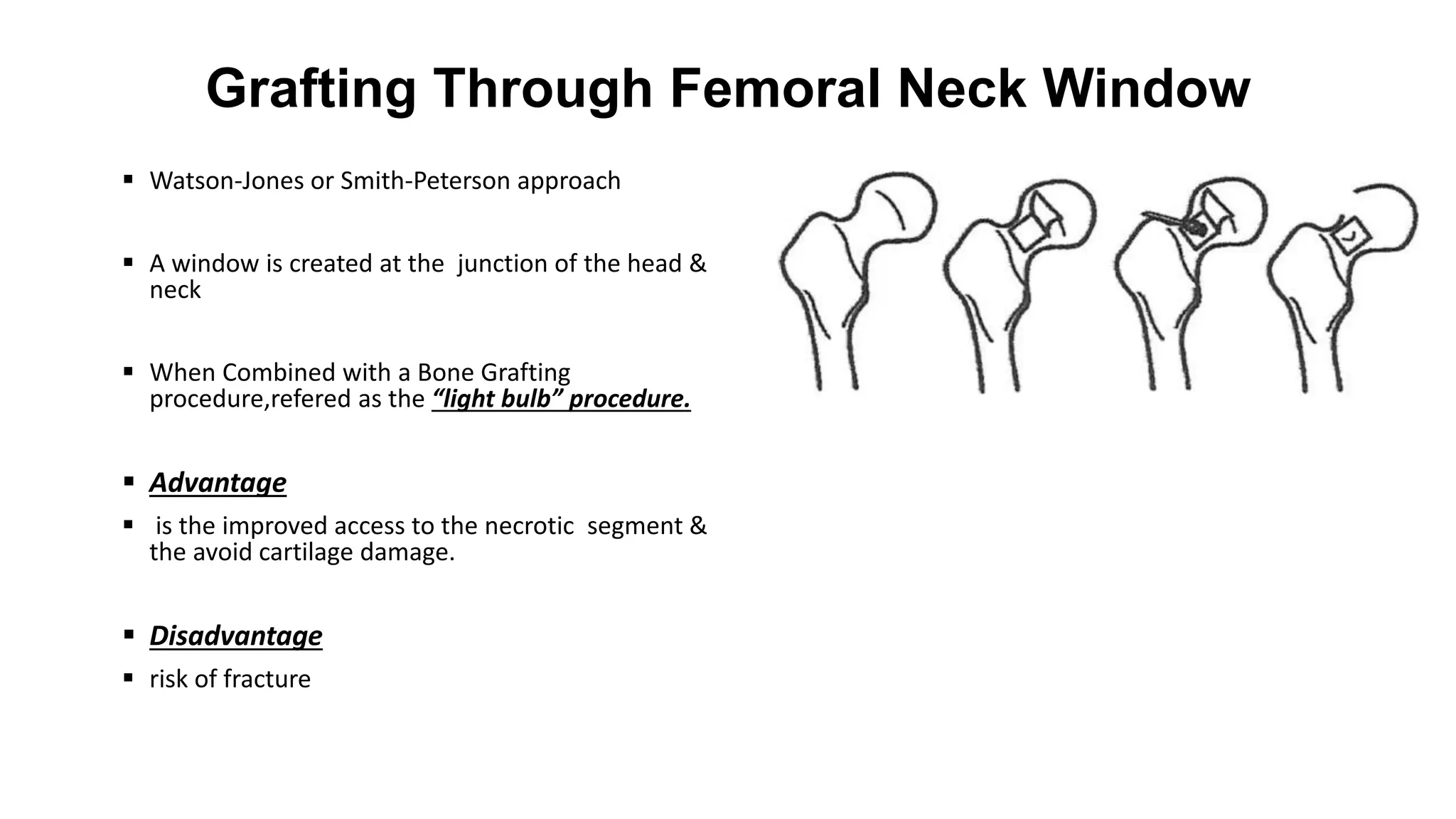 Hip anatomy, approaches & AVN | PPTX
