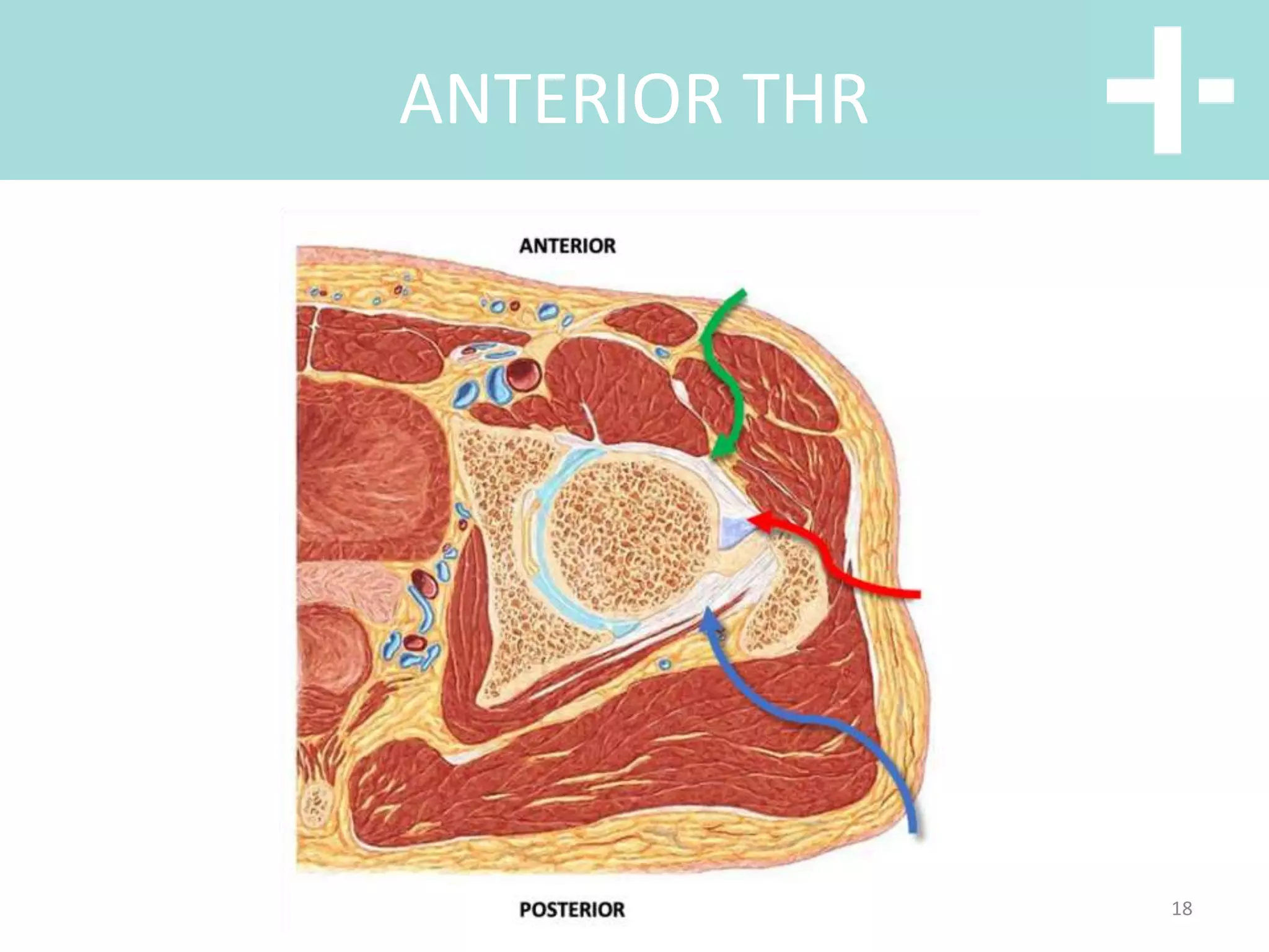 Hip anterior vs posterior total hip replacement | PPT