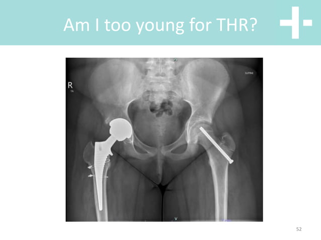 Hip anterior vs posterior total hip replacement