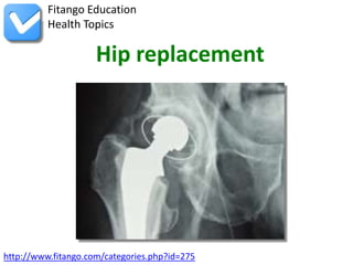 Hip replacement | PPTX