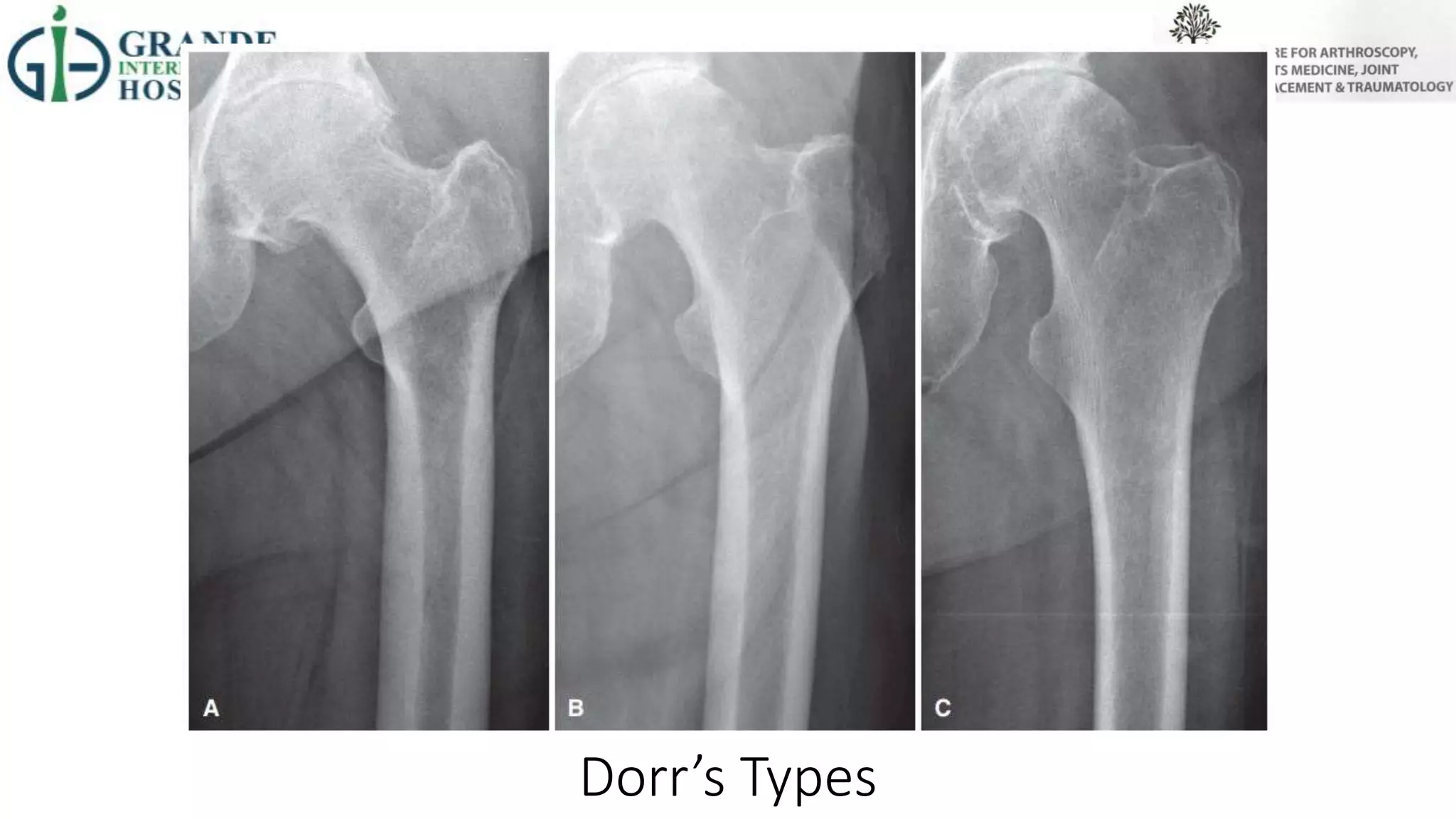 Hip - Anatomy and Biomechanics | PPTX