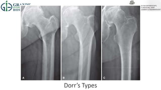 Hip - Anatomy and Biomechanics | PPTX