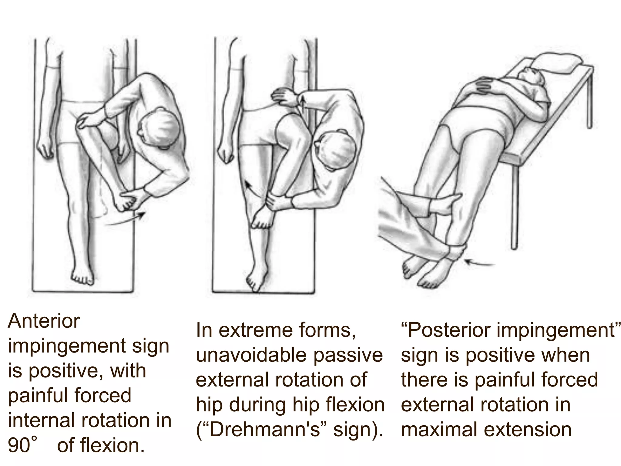 Hip and spine syndrome (PMR) | PPTX