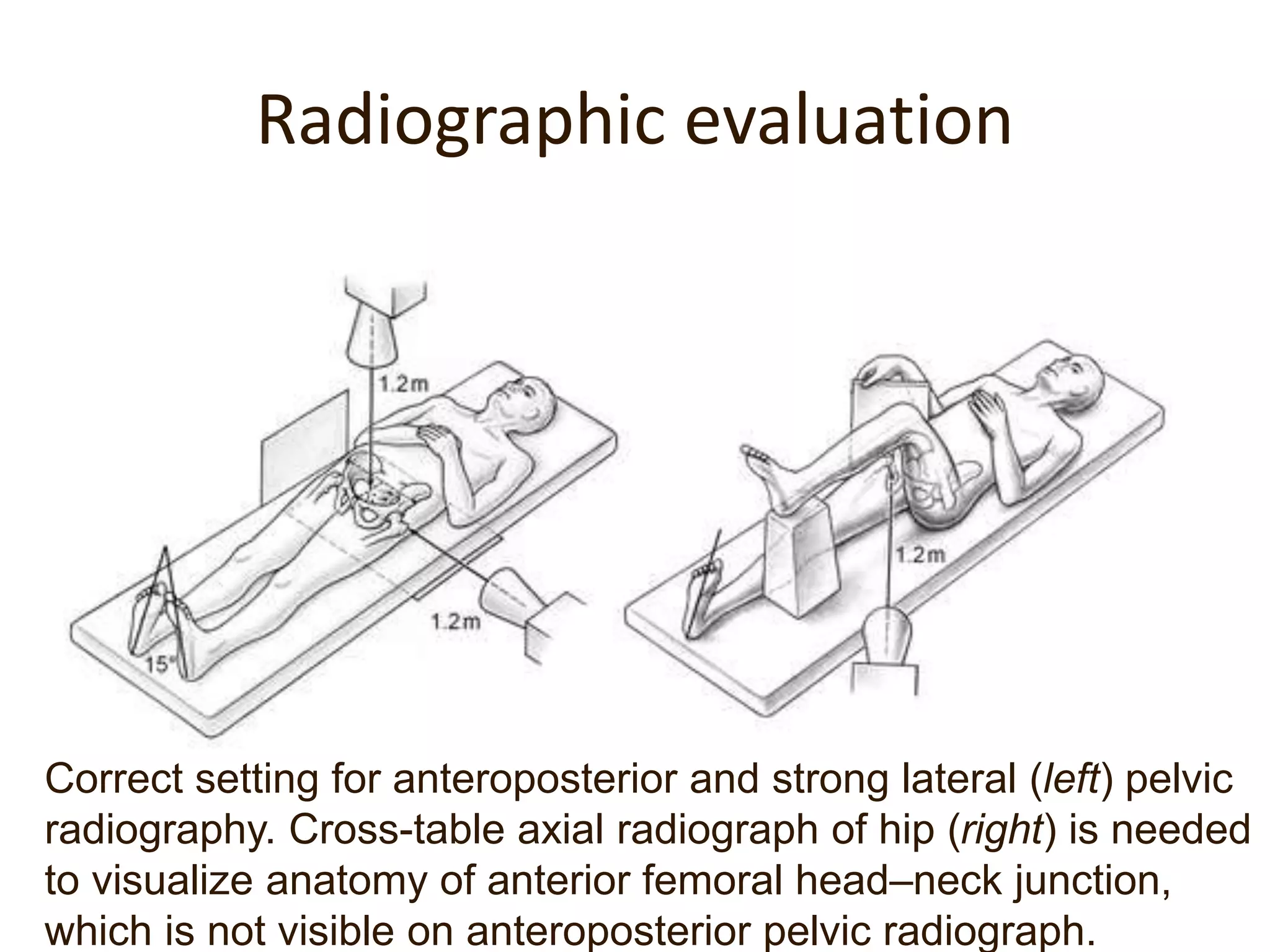 Hip and spine syndrome (PMR) | PPTX