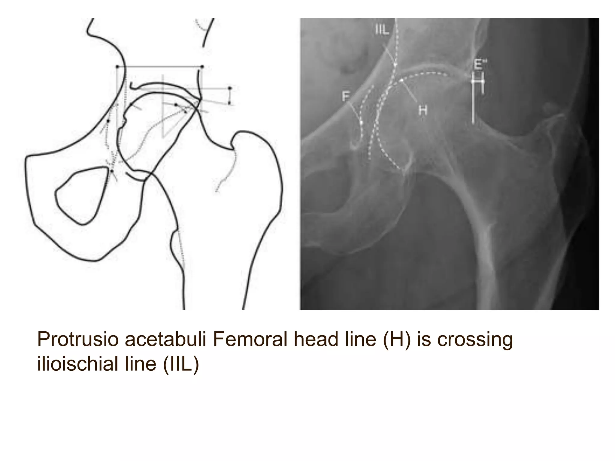Hip and spine syndrome (PMR) | PPTX