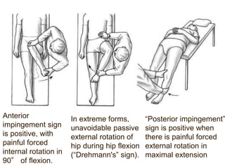 Hip and spine syndrome (PMR) | PPT