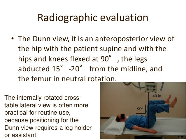 Hip and spine syndrome (PMR)