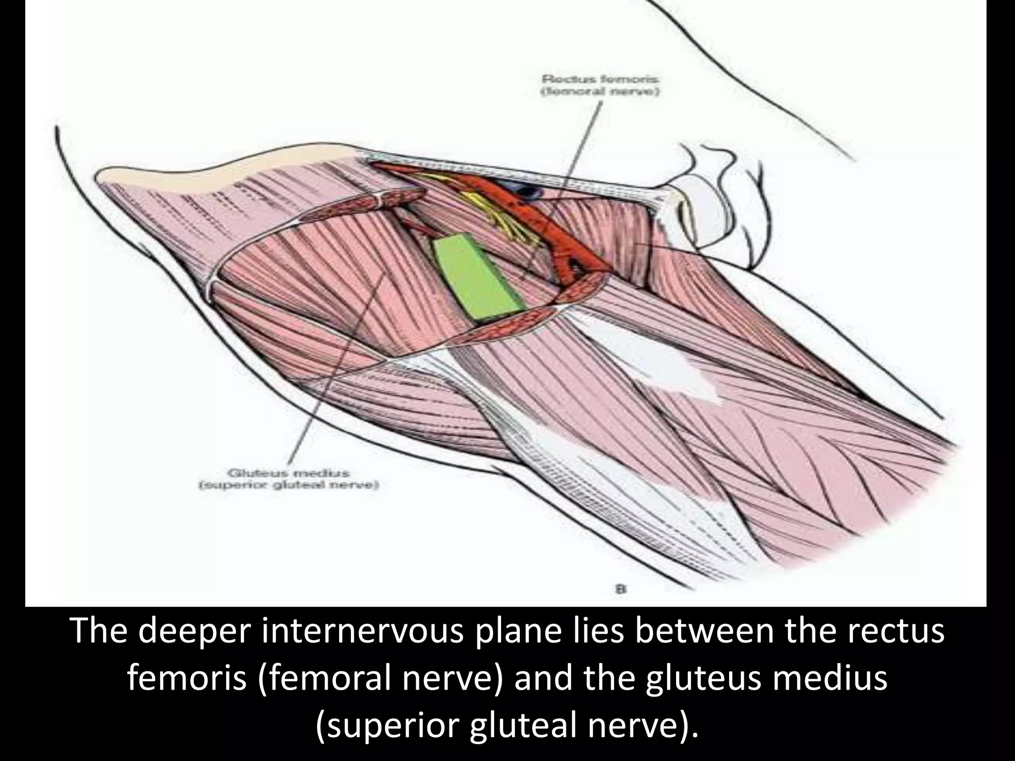 Surgical Approaches to Hip Joint | PPTX