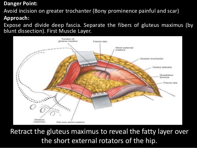 Surgical Approaches to Hip Joint