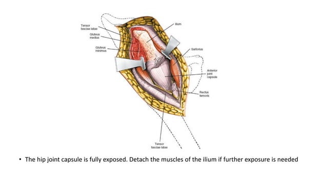 Surgical approaches to Hip.pptx