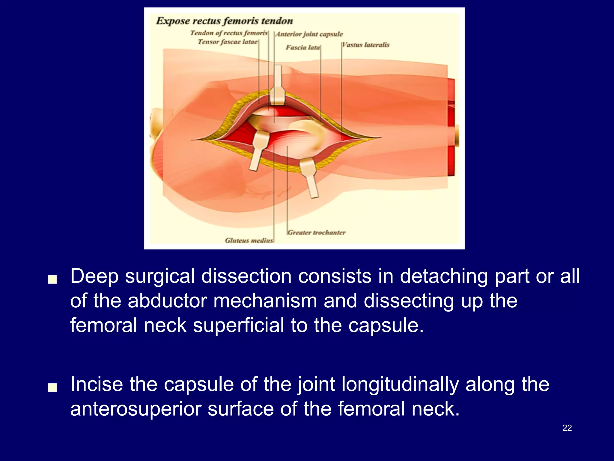 Hip Arthroplasty Approach.pdf