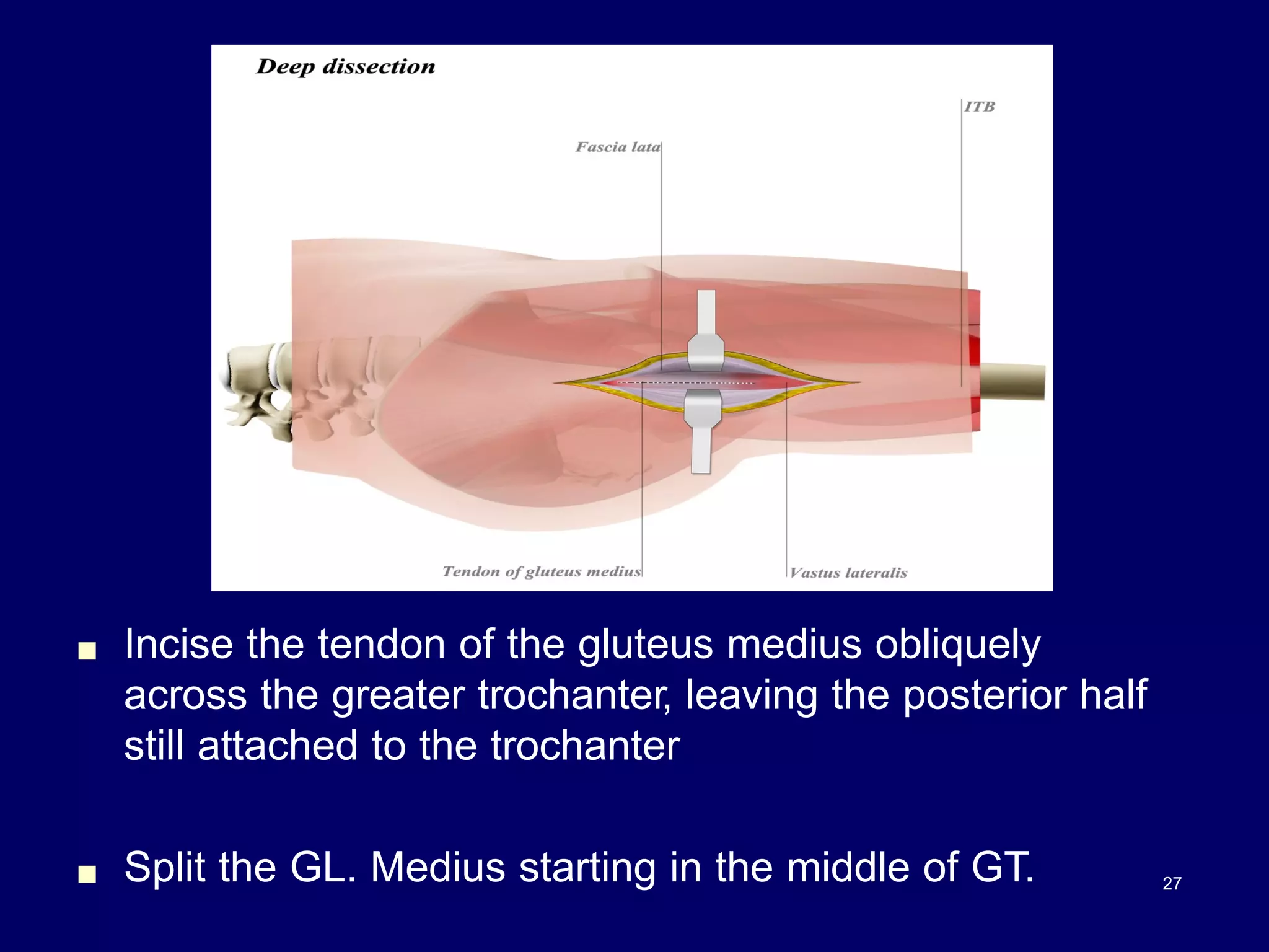 Hip Arthroplasty Approach.pdf