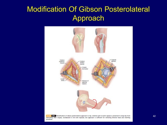 Hip Arthroplasty Approach.pdf