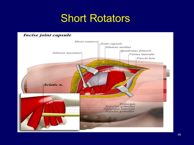 Hip Arthroplasty Approach.pdf