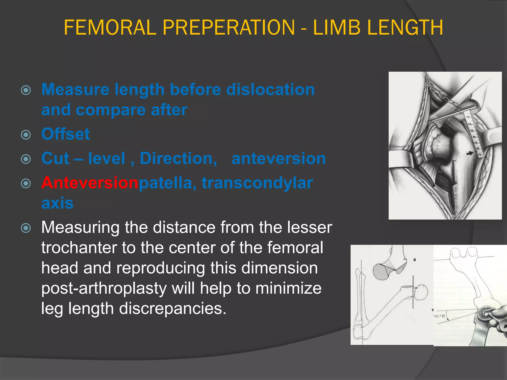 Hip arthroplasty surgical anatomy and approaches | PDF