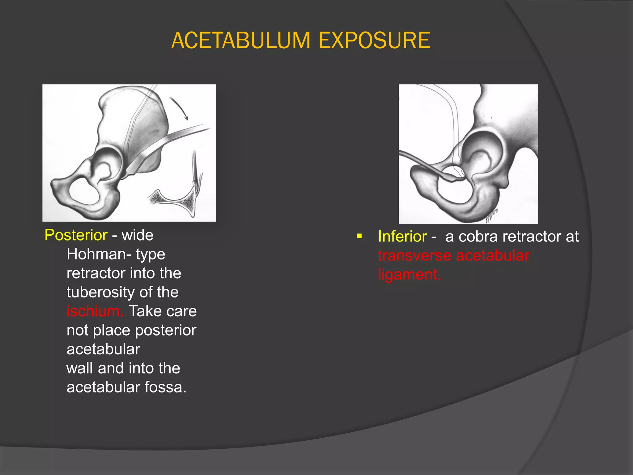 Hip arthroplasty surgical anatomy and approaches | PDF