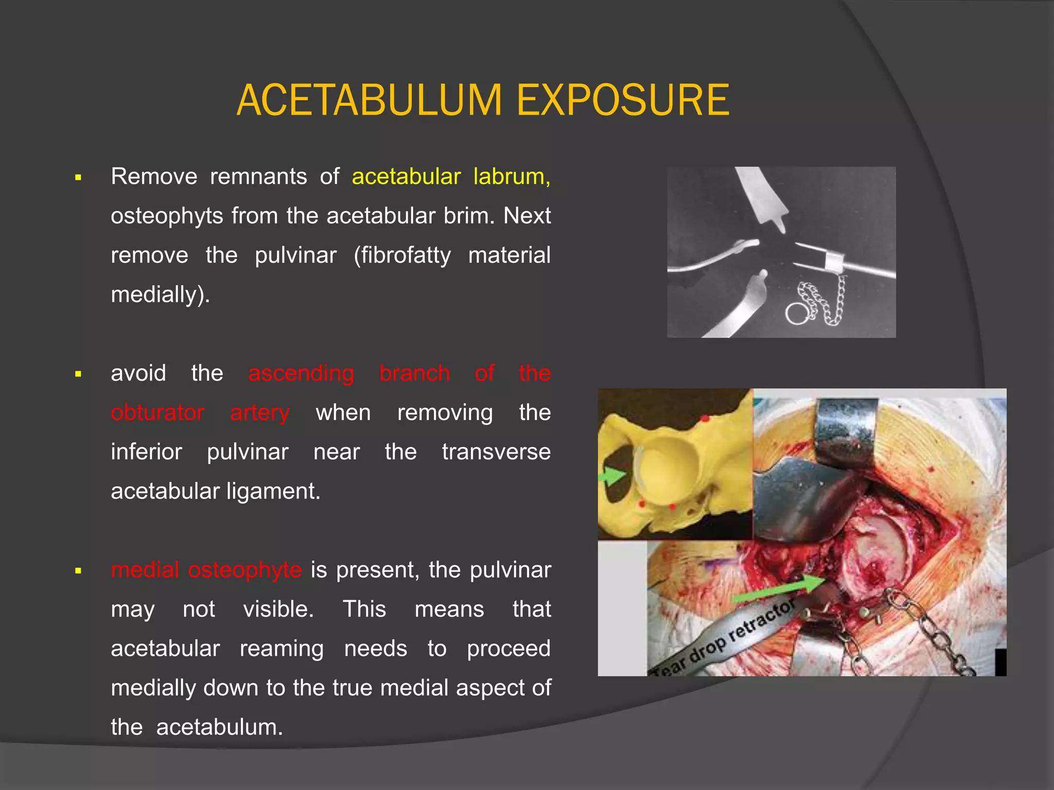 Hip arthroplasty surgical anatomy and approaches | PDF