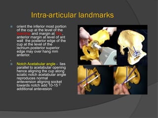 Hip arthroplasty surgical anatomy and approaches | PDF