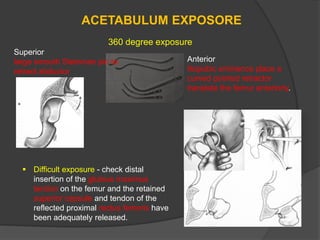 Hip arthroplasty surgical anatomy and approaches | PDF