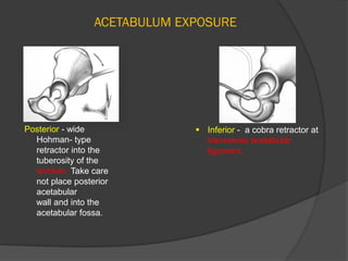 Hip arthroplasty surgical anatomy and approaches | PDF