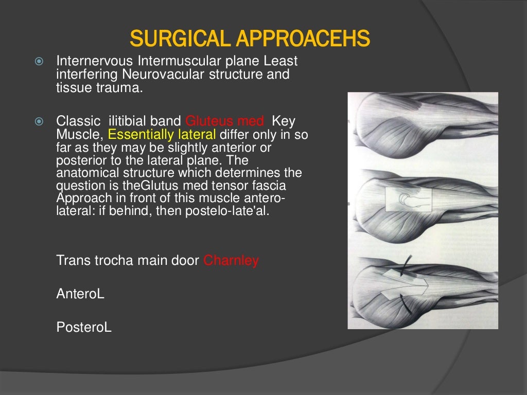 Hip arthroplasty surgical anatomy and approaches