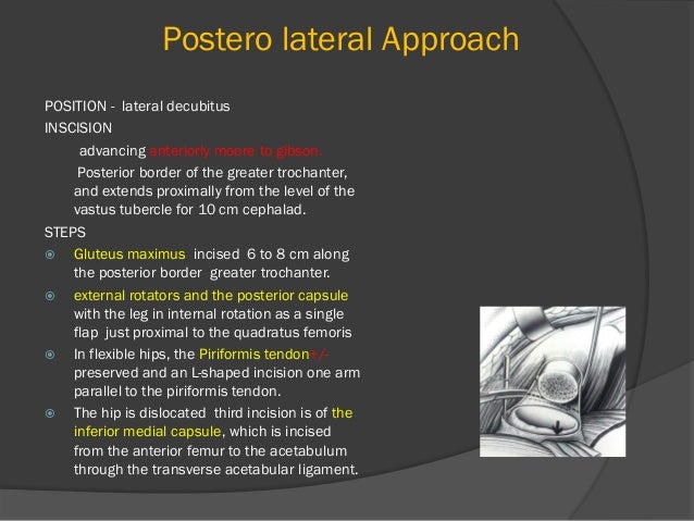 Hip arthroplasty surgical anatomy and approaches