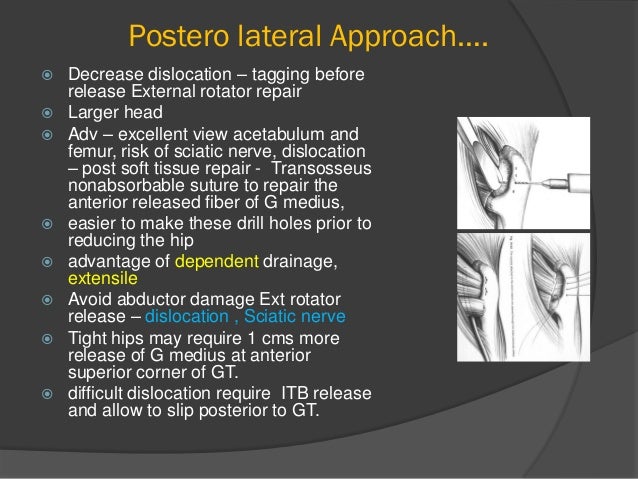 Hip arthroplasty surgical anatomy and approaches